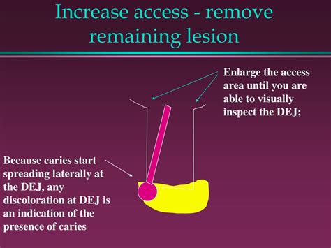 Ppt Class I And Ii Composite Restorations Principles And Techniques Powerpoint Presentation Id