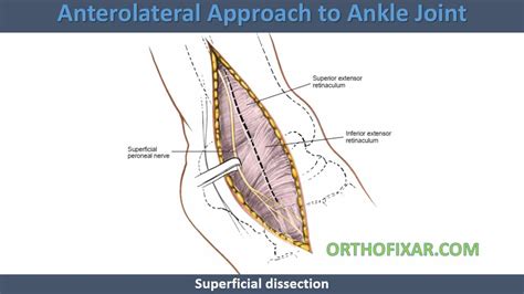 Anterolateral Approach To Ankle Joint • Full And Easy • Orthofixar 2025