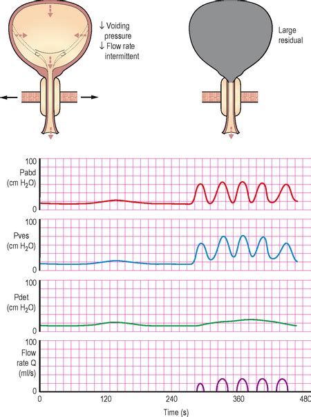 Voiding Disorders And Bladder Outlet Obstruction Abdominal Key