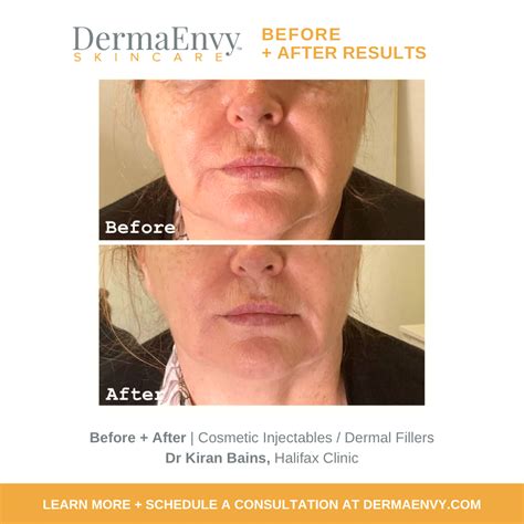 Dermal Filler Halifax Cosmetic Fillers Restylane Juvederm Near Me — Dermaenvy Skincare