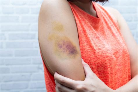 5 Reasons Why You Bruise So Easily Where Wellness
