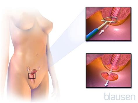 Imageleep法（loop Electrosurgical Excision Procedure） Msdマニュアル家庭版