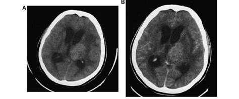 A Cranial Ct Scan Showing A Left Thalamic Calcified Mass With