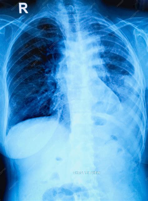 Premium Photo Xray Of Female Chest Findings Mild Pleural Effusion