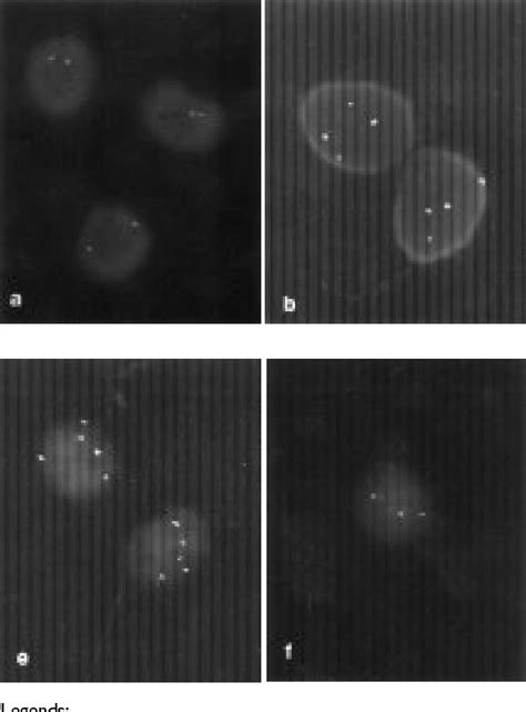 Figure 1 From Rapid Prenatal Diagnosis Of Chromosome Abnormalities