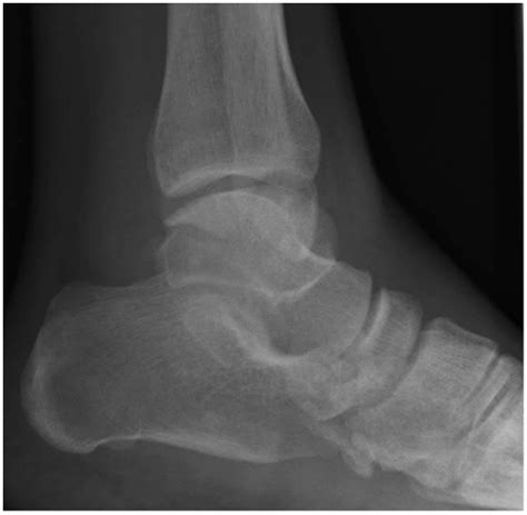 Foot Injuries In The Emergency Department Emdocs