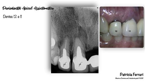 Remoção de Pinos Metálicos em dentes e Patricia Ferrari Endodontia