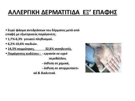ΔΕΡΜΑΤΙΤΙΔΑ