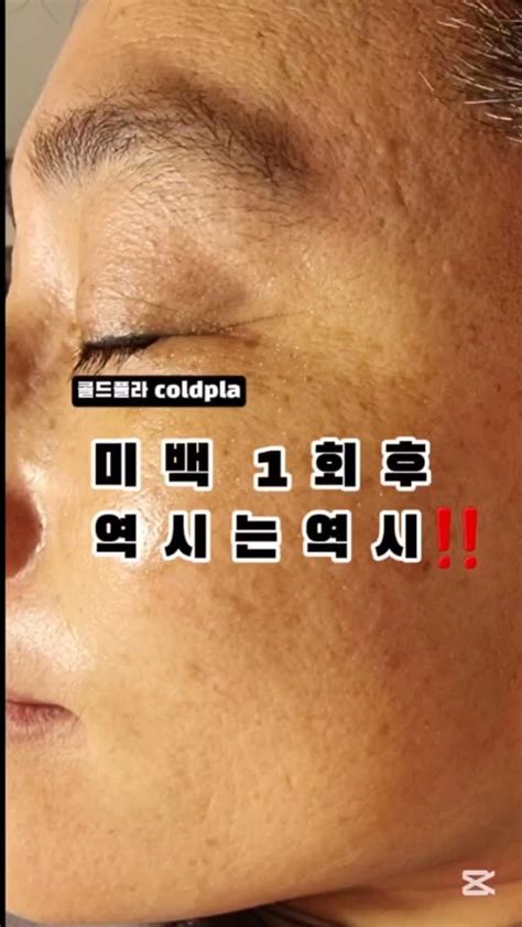 플라즈마 서대문지사 플라즈마교육 플라즈마블라스트 수강 은평구 피부관리 서대문 피부관리 이지뷰티랩 💚성인여드름 좁쌀