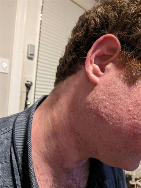 How To Treat Skin Rash Rdermatologyquestions