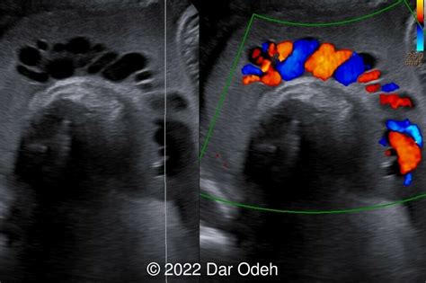 Echogenic Ultrasound