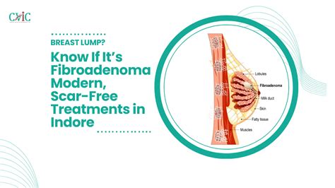 Breast Fibroadenoma Symptoms Diagnosis And Best Treatment In Indore