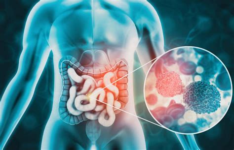 การตรวจ Fit Test คัดกรองมะเร็งลำไส้ใหญ่ Chg Cancer Center