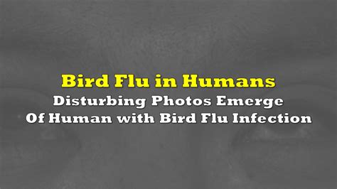 Disturbing Photos Emerge Of Texas Dairy Workers Rare Bird Flu