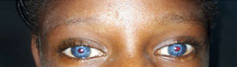 Bilateral Complete Hypoplastic Blue Irides In Case 2 Download