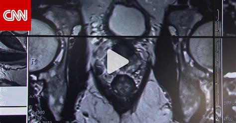 Prostate Cancer Awareness Uncover Early Warning Signs And Screening