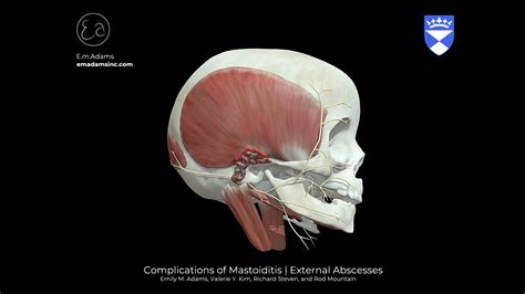 Zygomatic Abscess 3d Model By University Of Dundee Cahid Anatomy