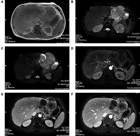 MRI Manifestations Of Hepatic Sarcomatoid Carcinoma The Magnetic