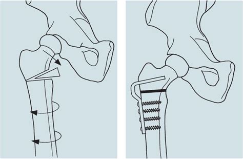 Single Event Multilevel Surgery Semls Procedures