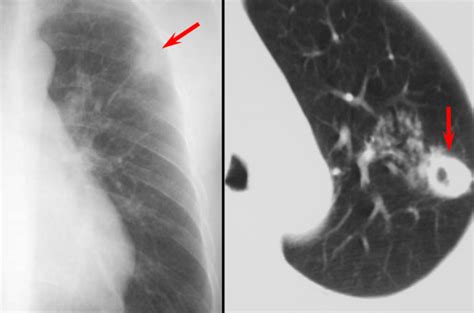 Tuberculosis Series Physical Manifestations Of Tb Infection Ethnomed