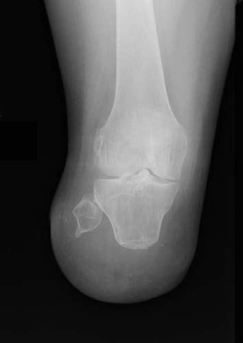 Below Knee Democratiz3d® Processing
