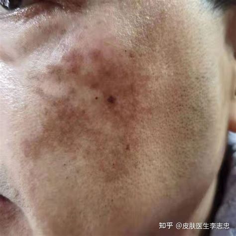 化瘀散结第一方——桂枝茯苓丸！不仅祛斑还除包块、囊肿、结节 知乎