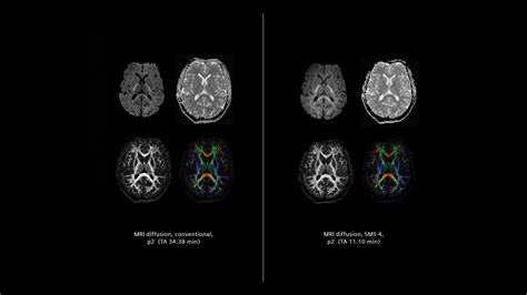 Simultaneous Multi Slice Siemens Healthineers
