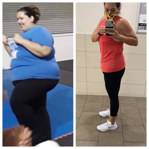 7 Most Inspiring Gastric Bypass Before And After Tran