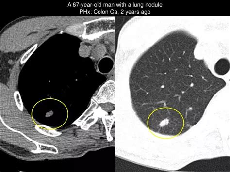 Ppt Chest Ct Powerpoint Presentation Free Download Id4963269