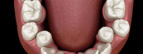 Innovative Orthodontic Solutions To Combat Dental Crowding Woodlawn Ortho