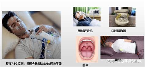 深度科普贴打鼾打呼噜怎么办止鼾喷雾 鼻贴 牙套 喉部振动器 止鼾枕 呼吸机如何避坑全网最全的近万字止鼾行业分析深度解读一文讲透