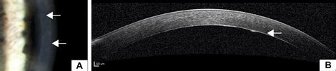Anterior Segment Optical Coherence Tomography For The Diagnosis Of