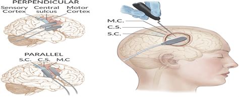 Long Term Results Of Cortical Motor Stimulation For Neuropat Neurosurgery