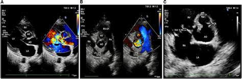 Pre Operative Echocardiography A Long Axis View Of The Left