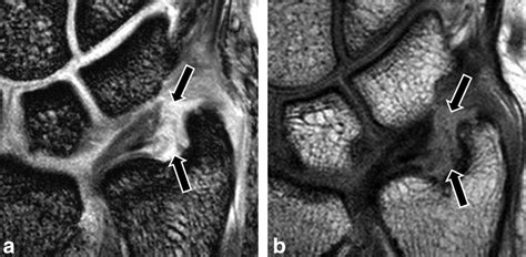 Triangular Fibrocartilage Complex Mri