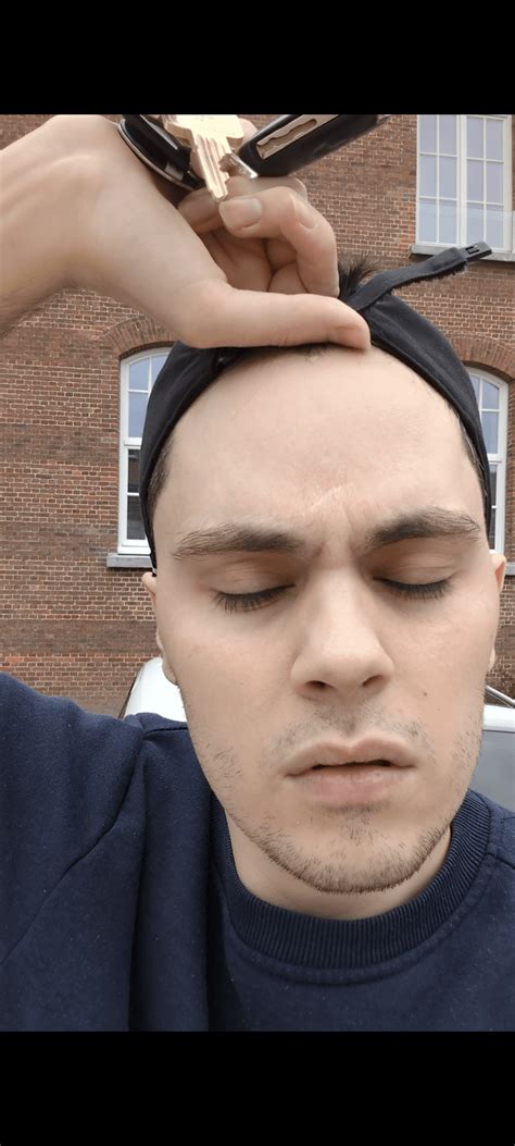 Linear Morphea R Scleroderma