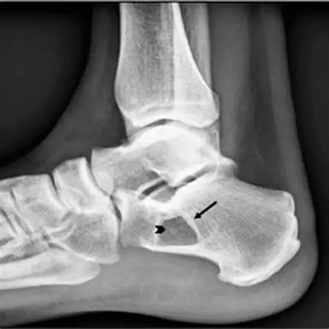 X Ray Left Calcaneum Ap Axial Test Price In Delhi Ganesh Diagnostic