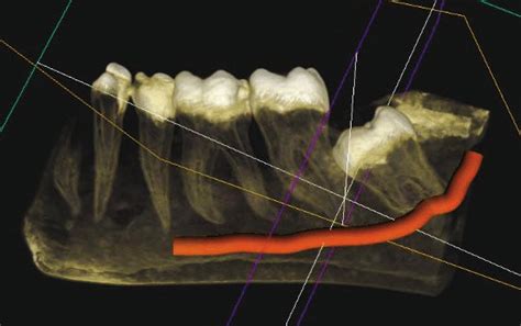 Close Proximity Of The Impacted Lower Third Molar To The Inferior