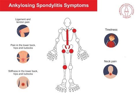 Systemic Sclerosis Scleroderma Dr Urk Rao