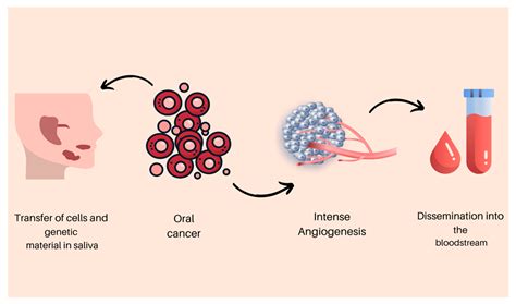 Circulating Mirna As A Biomarker In Oral Cancer Liquid Biopsy