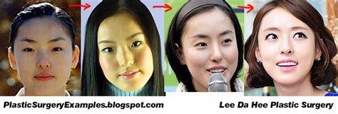 Lee Da Hee Plastic Surgery