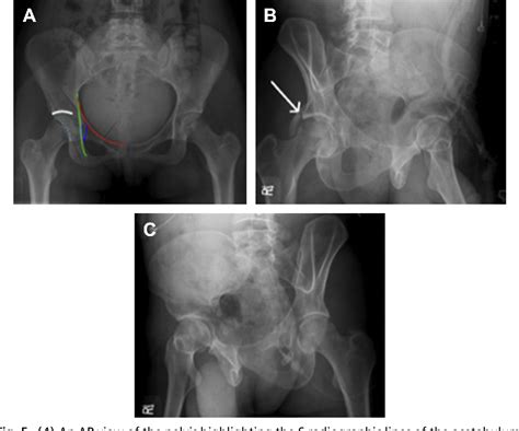 Figure 5 From Fragility Fractures Requiring Special Consideration