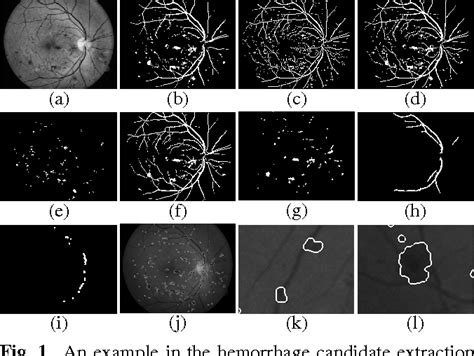 Figure 1 From Automatic Hemorrhage Detection In Color Fundus Images Based On Gradual Removal Of