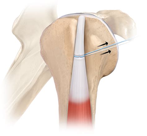 Arthrex Knotless Fibertak® Biceps Tenodesis