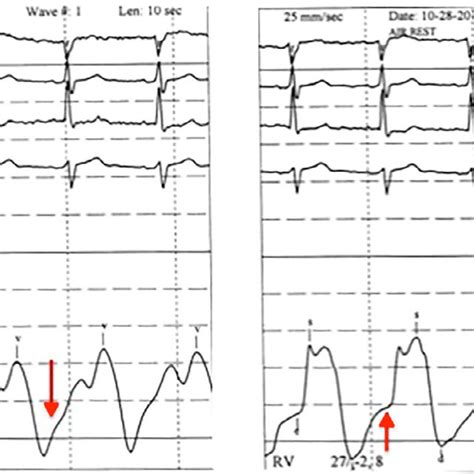 Right Heart Catheterization Showing Prominent V Wave And Abrupt Y