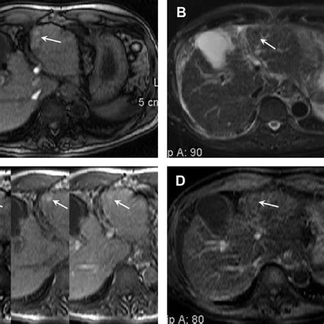Pdf Characterization Of Hyperintense Nodules On T1 Weighted Liver
