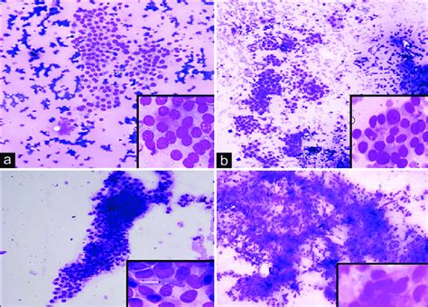 A Bethesda Category Ii Multiple Follicles With Thin Colloid In