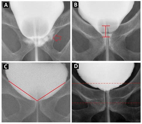 Illustration Of Cystography Feature A Urinary Leakage In Download Scientific Diagram
