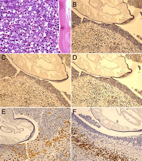 A Suppurative Granulomas Consisted Of Macrophages Epithelioid Cells
