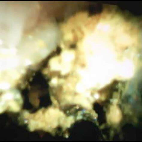 A Visualized Stone On Cholangioscopy Seen In The Distal Common Bile